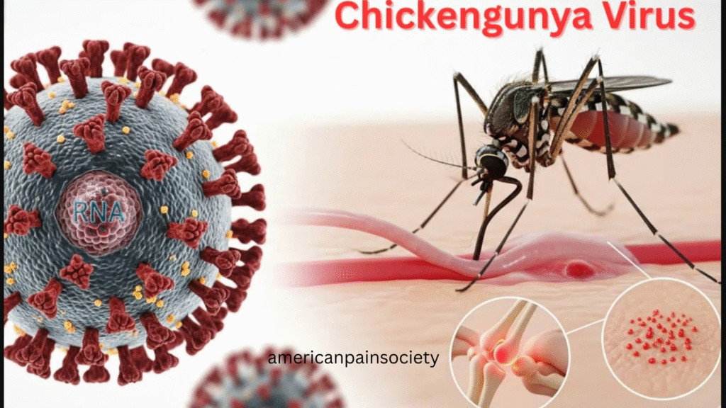 Chikungunya Virus – Causes, Symptoms, Diagnosis Full Guide
