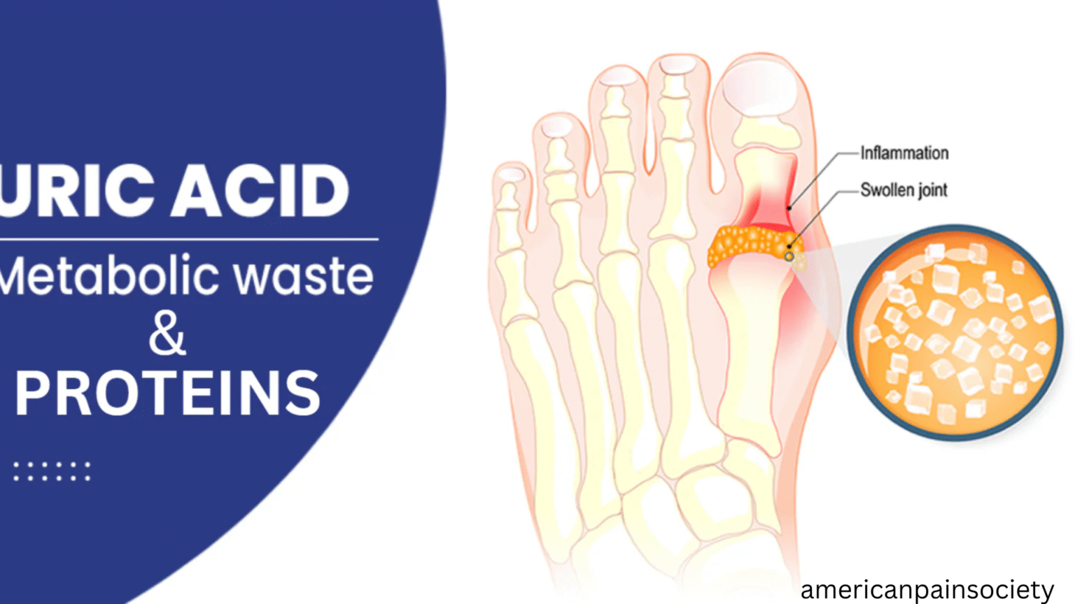 Does Protein Powder Really Raise Uric Acid Levels? Causes, Risks